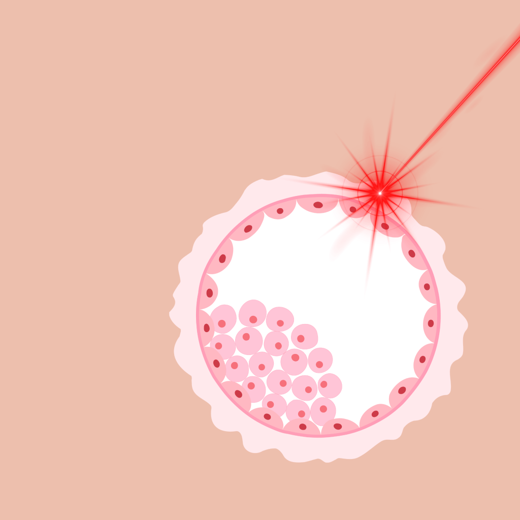 Laser Assisted Hatching in IVF- Is it Beneficial?