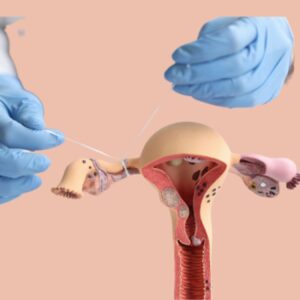 Tubal factor - Dr. Chaitra | Fertility Expert
